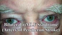 riMLF Syndrome from Artery of Percheron Stroke | Eccles Health Sciences ...