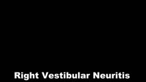Abnormal Head Impulse Test in Vestibular Neuritis 1 Week After Onset ...
