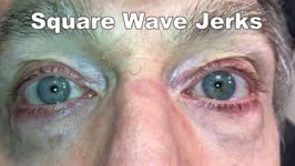 Saccadic intrusions (square wave jerks, SWJ) | Eccles Health Sciences ...