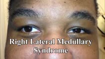 Saccadic Dysmetria and Ocular Lateropulsion in Lateral Medullary Stroke ...