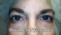 Downbeat Nystagmus and Convergence Spasm | Eccles Health Sciences ...