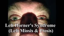 Apraclonidine Testing in Horner's syndrome | Eccles Health Sciences ...
