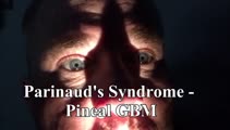 Parinaud's Syndrome in a Man with GBM of the Pineal Gland | Eccles ...