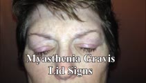 Typical Lid Signs (Cogan's Lid Twitch, Lid Hopping, Enhanced Ptosis) in ...