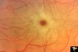 Macular cherry red spots in Niemann Pick disease | Eccles Health ...